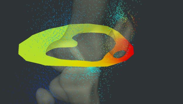 Bionic knee gives new life to arthritis patients | kgw.com